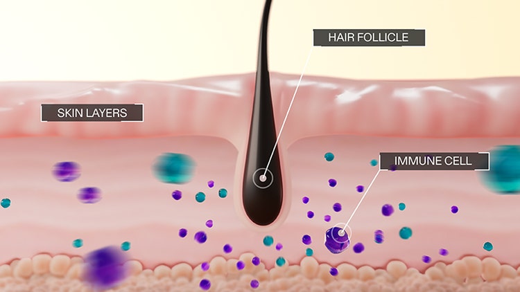 How LITFULO™ (ritlecitinib) Works | Safety Info